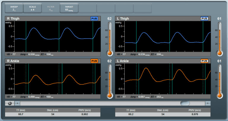 Pulse Wave Velocity (PWV) Test for Arterial Stiffness