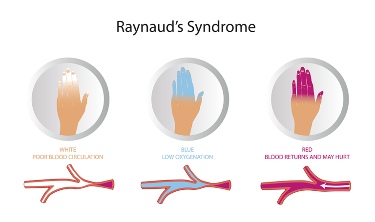 Prueba del síndrome de Raynaud con máquina vascular - Viasonix