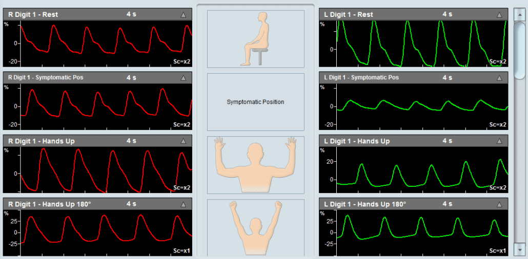Thoracic Outlet Syndrome (TOS) Test - Viasonix